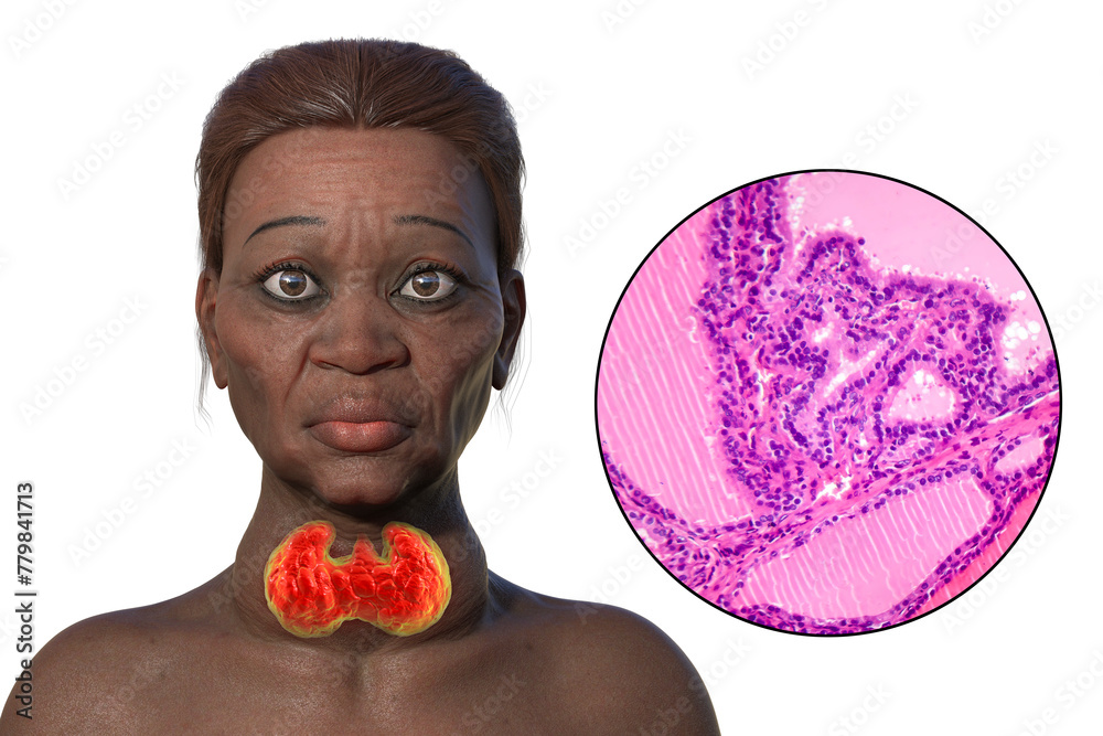 Photo & Art Print Grave's disease in a woman, 3D illustration and light ...