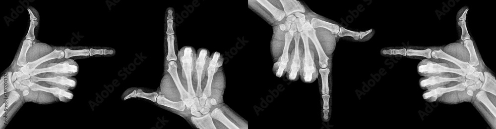 Film xray x-ray or radiograph of a thumb and finger in gestural ...