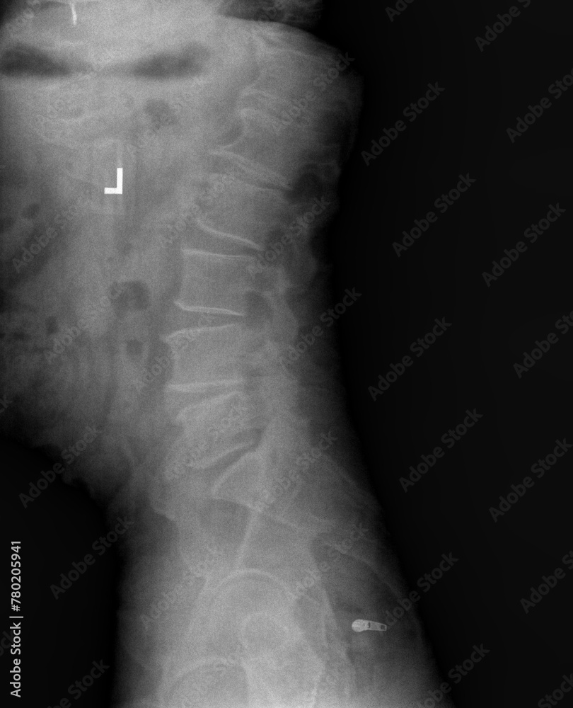 Film xray or radiograph of lumbar low back vertebrae showing facet ...