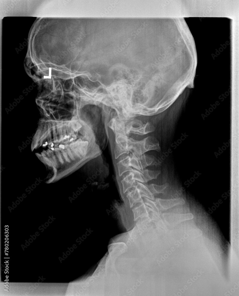 Film x ray or radiograph of a cervical neck. Lateral side view showing ...