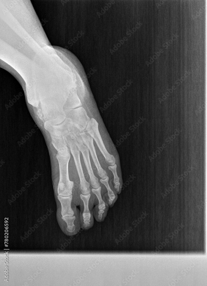 Film xray or radiograph of a normal foot, ankle and leg. dorsal ...