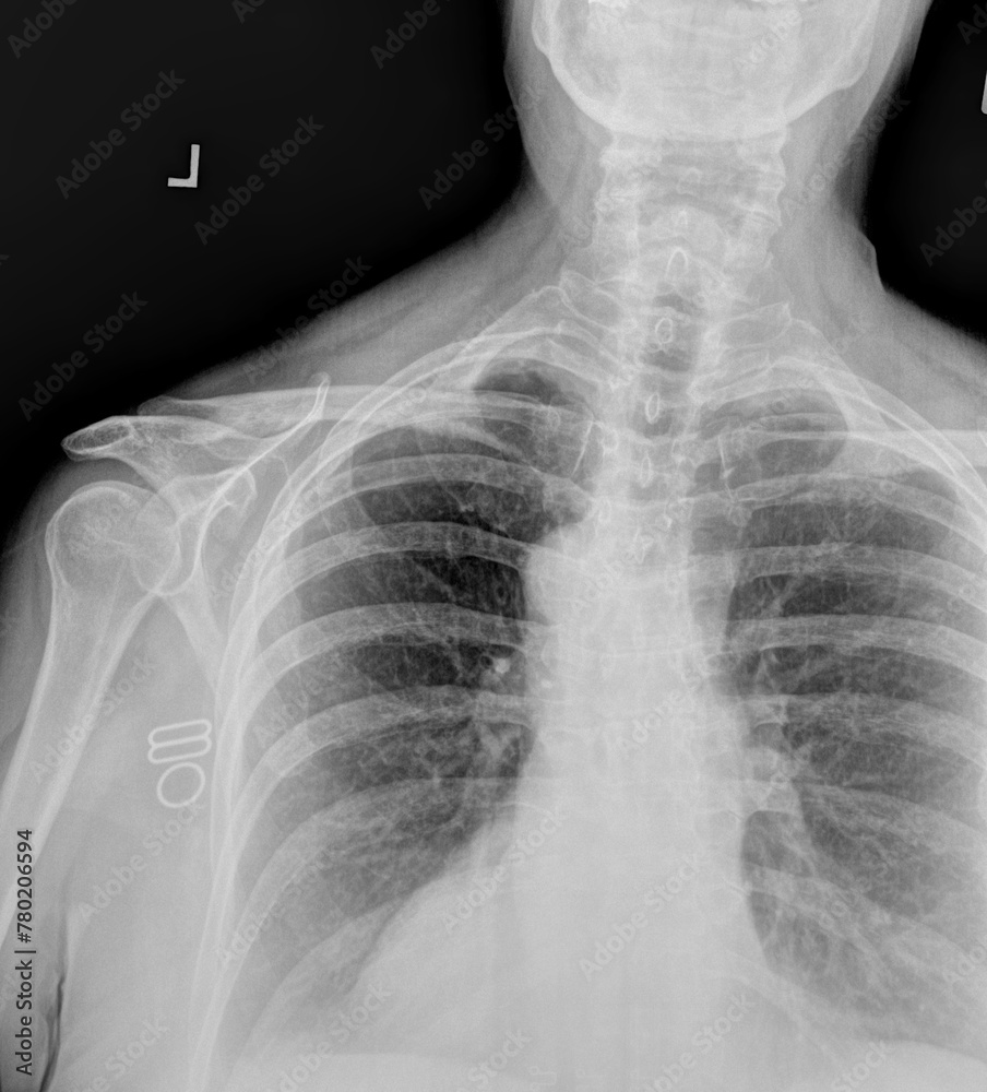 Film x ray or radiograph of a normal adult cervical vertebrae and left ...