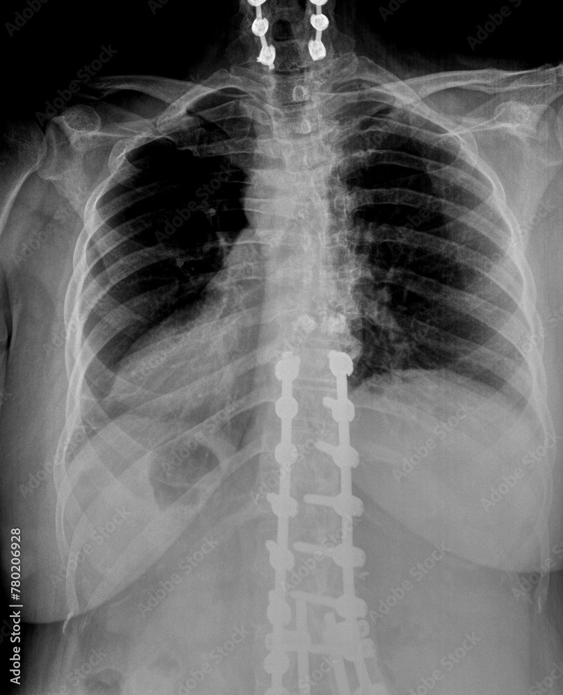 Film xray or radiograph of a mid back thoracic and cervical vertebrae ...
