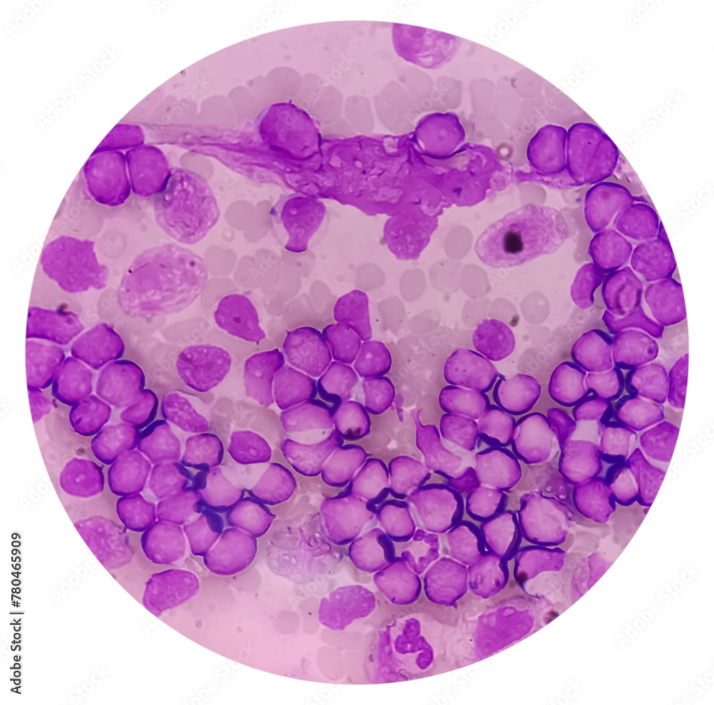 Acute leukemia, ALL(Acute lymphoblastic leukemia), peripheral blood smear, Under 100x light ...