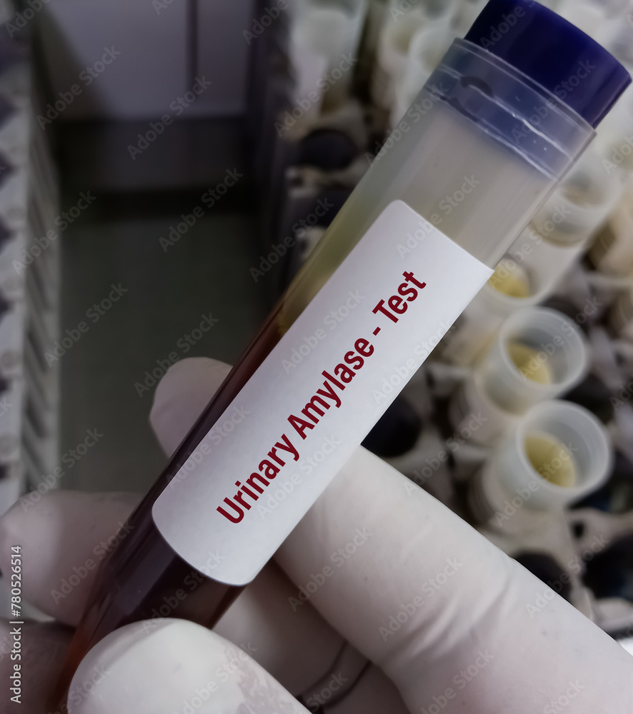 Hand hold urine sample for urine amylase test. Urinalysis. Stock Photo ...