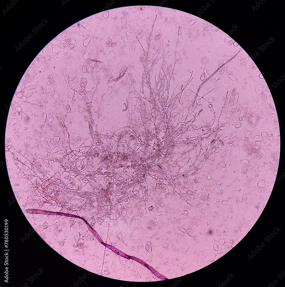 Pseudo hyphae and budding yeast cells in patient urine (urinary tract ...