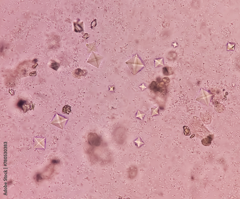 UTI. Budding yeast cells and calcium oxalate crystal in urine, urinary ...
