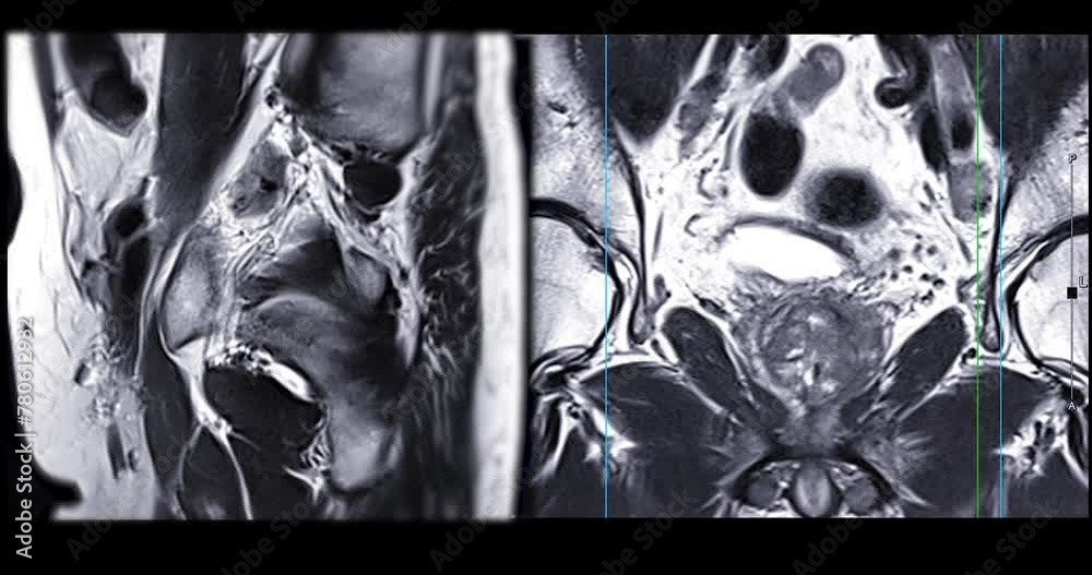 MRI of the prostate gland reveals A 2.0x0.9x1.7 cm malignant prostate ...