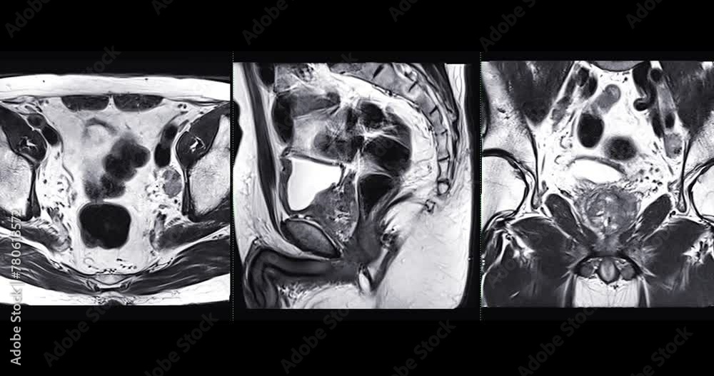 MRI of the prostate gland reveals A 2.0x0.9x1.7 cm malignant prostate ...