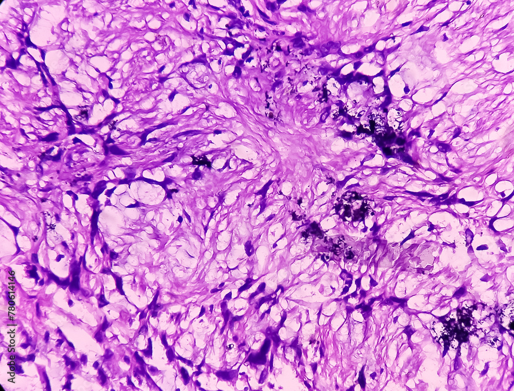Salivary mucoid cyst. microscopic show parotid tissue, features of cyst ...