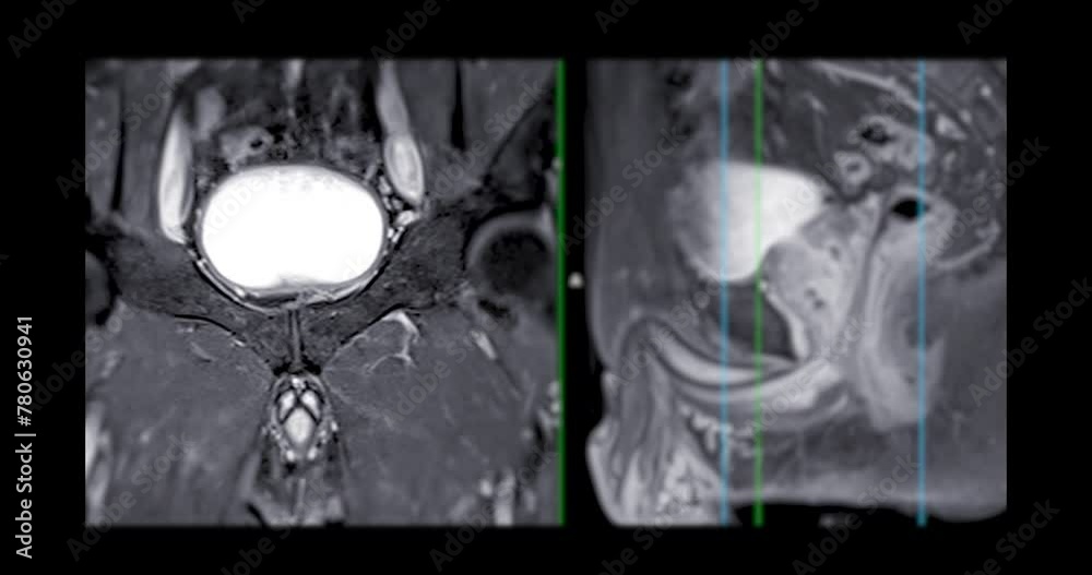 MRI of the prostate gland, revealing an enlarged size, aids in ...