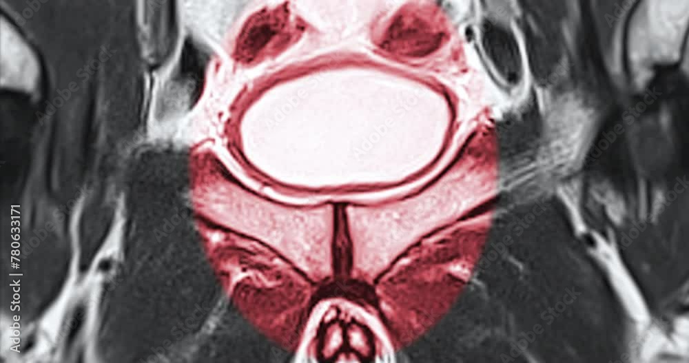MRI of the prostate gland, revealing an enlarged size, aids in ...