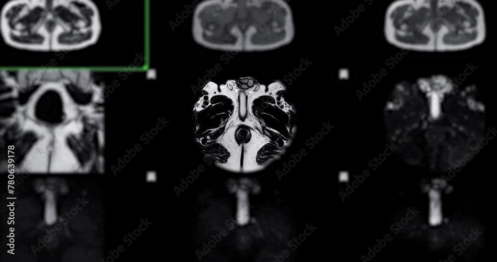 Vidéo Stock MRI of the prostate gland reveals a focal abnormal signal ...