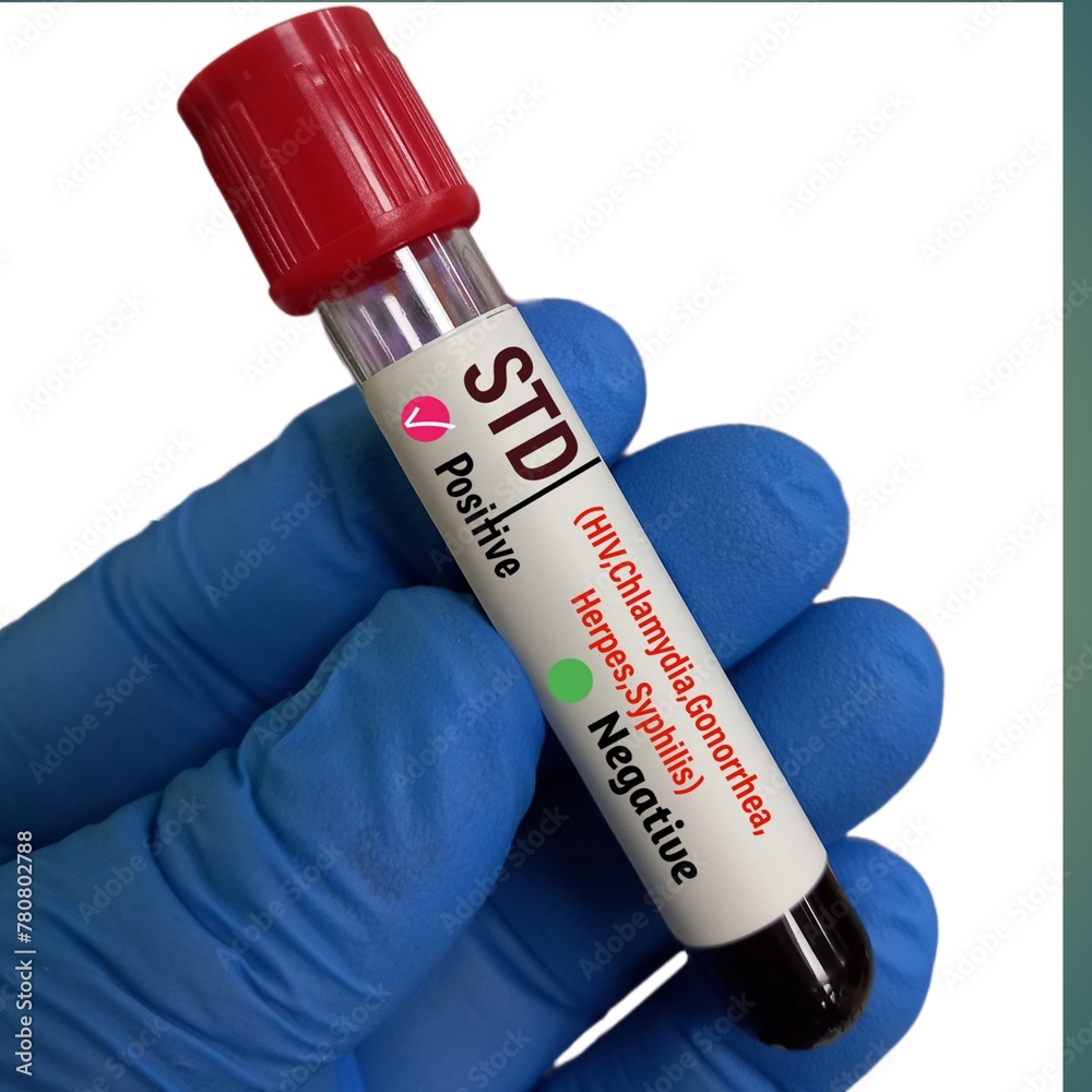 Scientist holds Blood sample for STI or STD (Sexually Transmitted ...