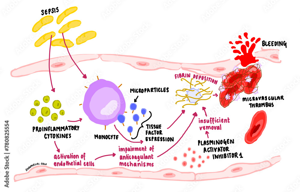 Poster Pathogenesis of Disseminated Intravascular Coagulation – Wall ...