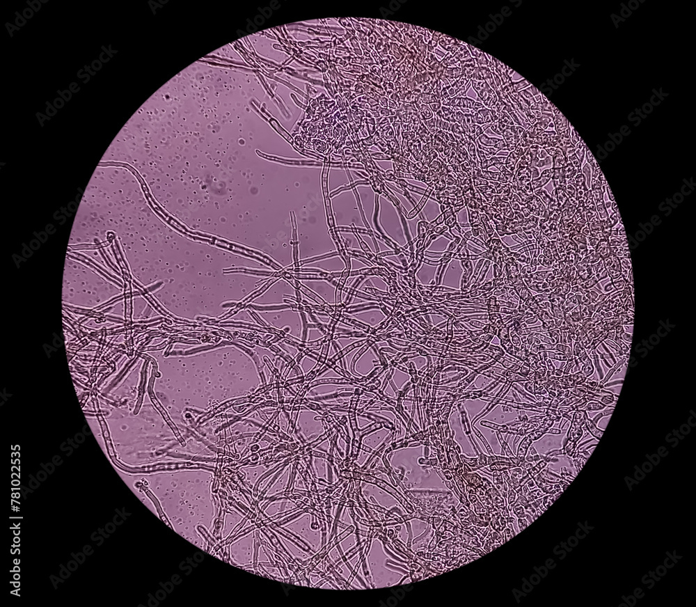 Microscopic fungi Malassezia furfur, showing yeast cells and hyphae ...