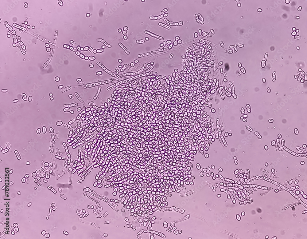 Microscopic fungi Malassezia furfur, showing yeast cells and hyphae ...