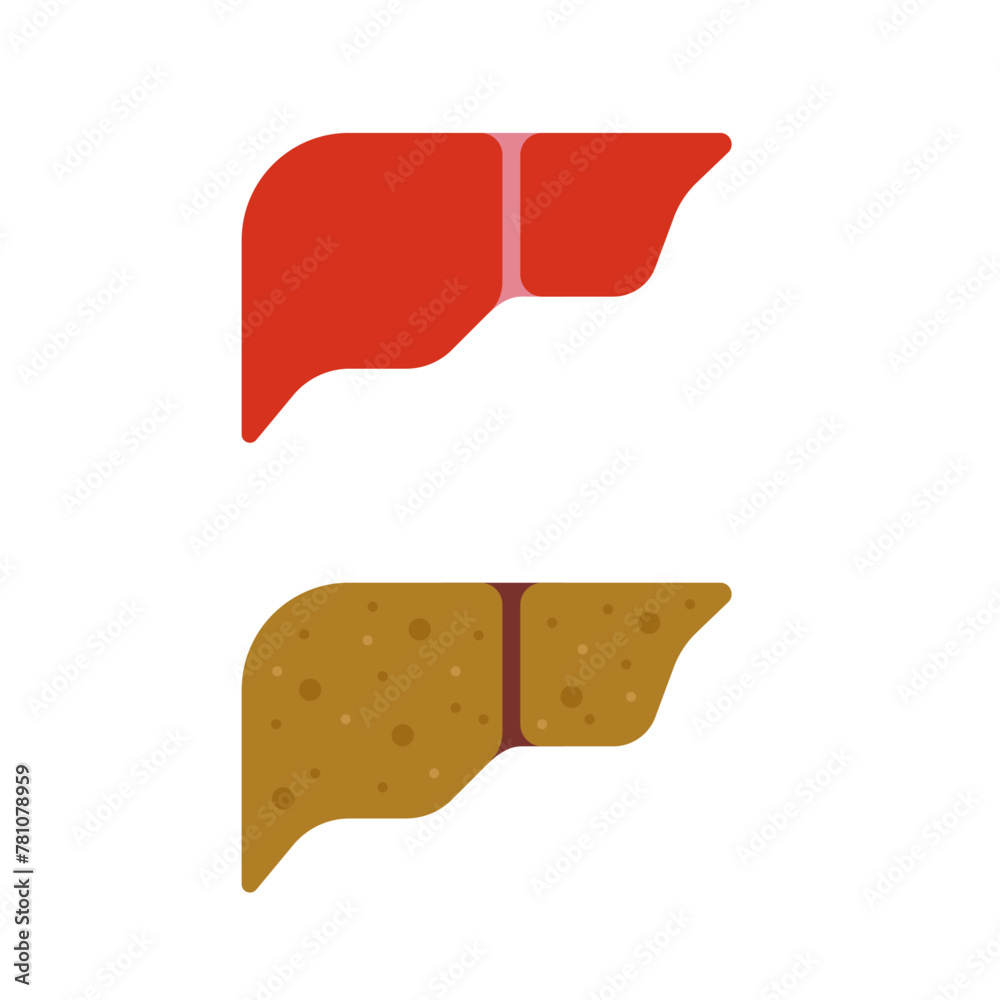 healthy liver and bad liver flat vector illustration isolated on white ...