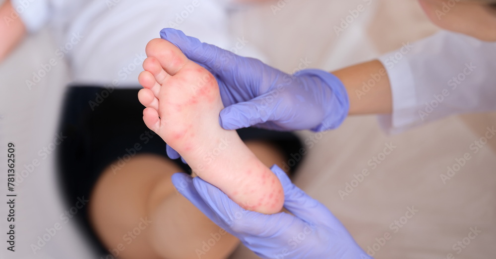 Rash with enterovirus infection of picornavirus family on feet of child ...