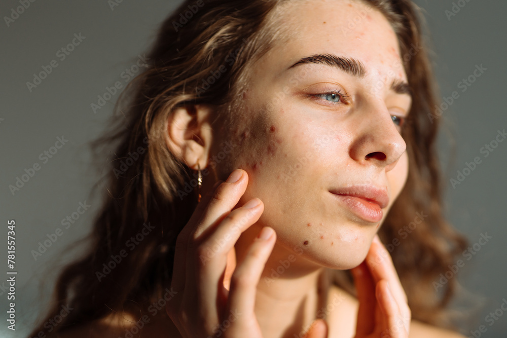 Portrait of a beautiful young woman with rash skin, scar, and red skin ...