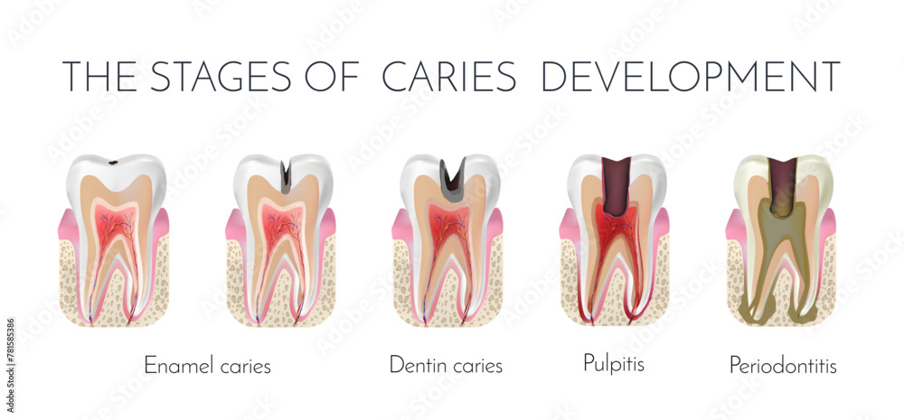 Tooth decay. The stages of caries development. Enamel and dentin caries ...