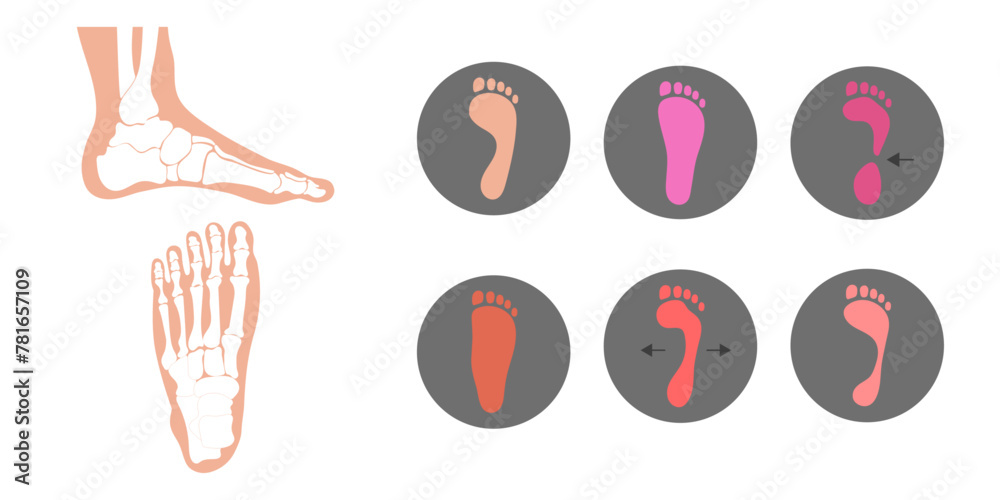 Types of deformity foot Stock Vector | Adobe Stock