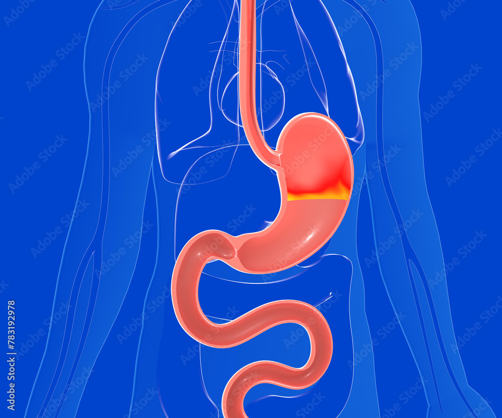 Anatomical 3D illustration of stomach with heartburn and reflux. On a ...