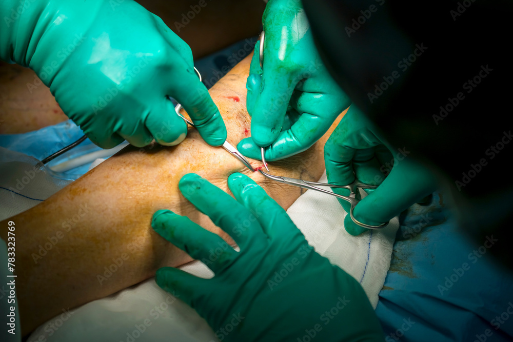 Process of varicose vein surgery in hospital, vein sealing, venous ...