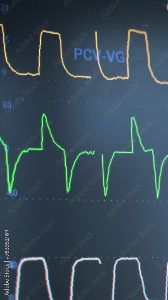 Screen of monitor during surgery in operating room. Emergency room with ...