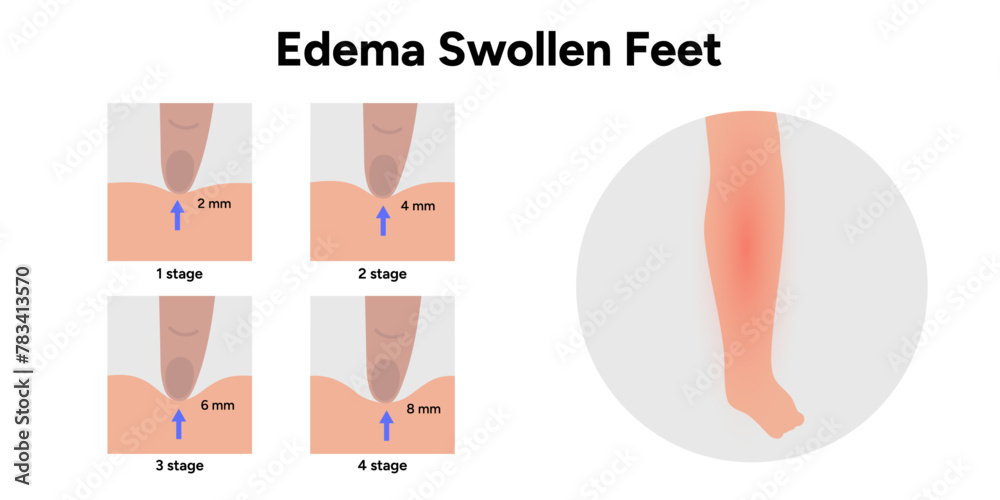 Edema swollen feet Stock Vector | Adobe Stock
