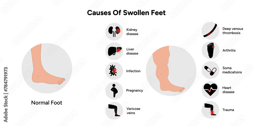 Causes of swollen feet. Orthopedist diagram and infographic Stock ...