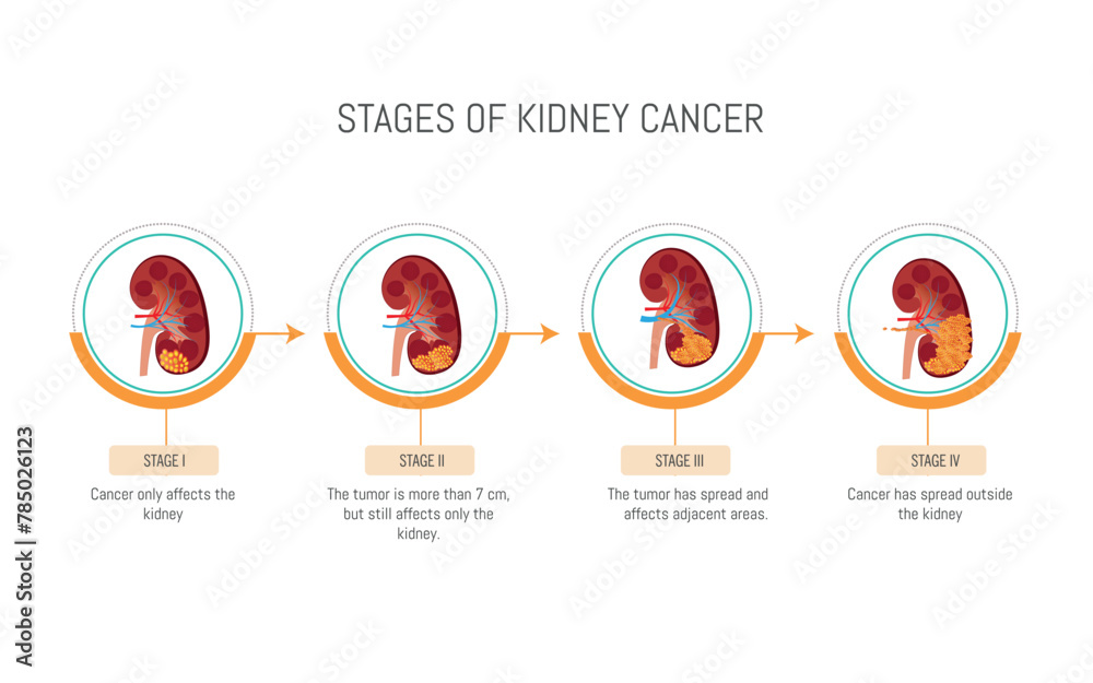 A diagram of the stages of kidney cancer. The stages are: Stage I ...