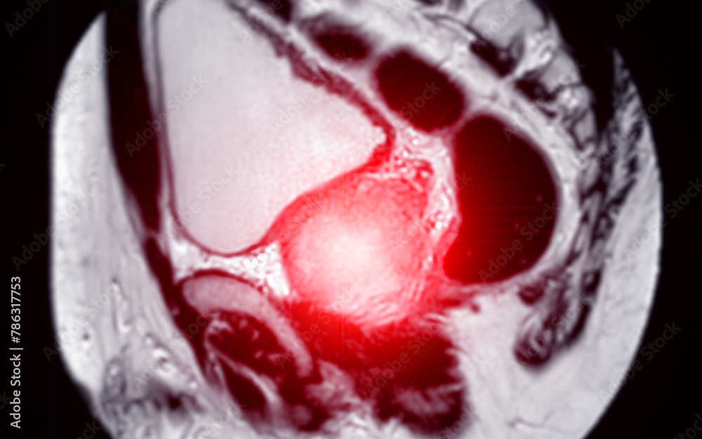 MRI of the prostate gland reveals a focal abnormal signal intensity (SI ...