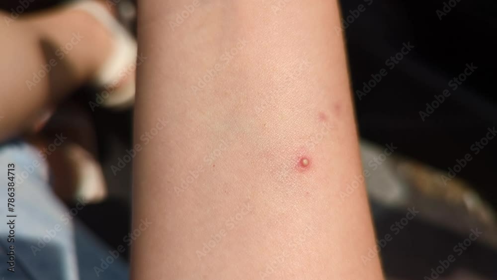 A purulent fistula on a person's skin in the area of the forearm ...