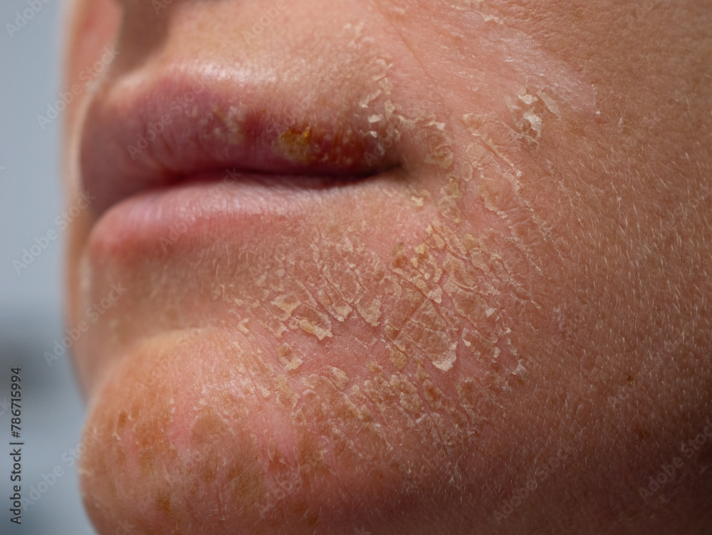 CLOSE UP, DOF: Seriously damaged epidermis of skin on the face of a ...