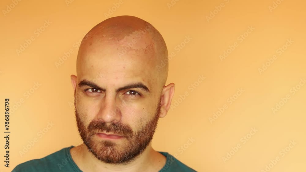 Bearded bald man with heavily sunburned head showing where the skin's ...