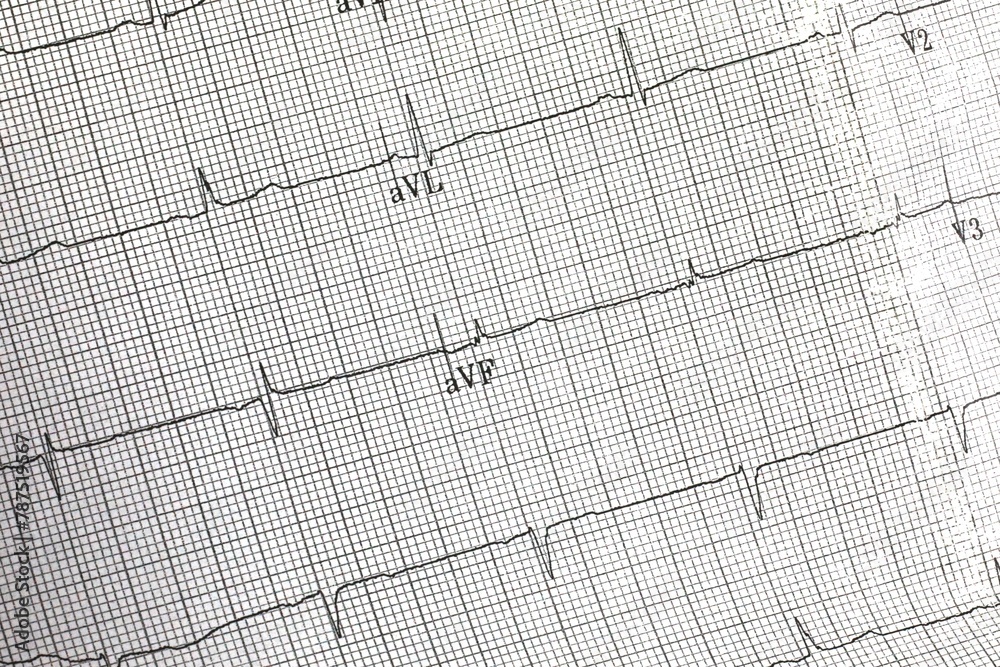 EKG test results from a patient with heart failure Stock Photo | Adobe ...