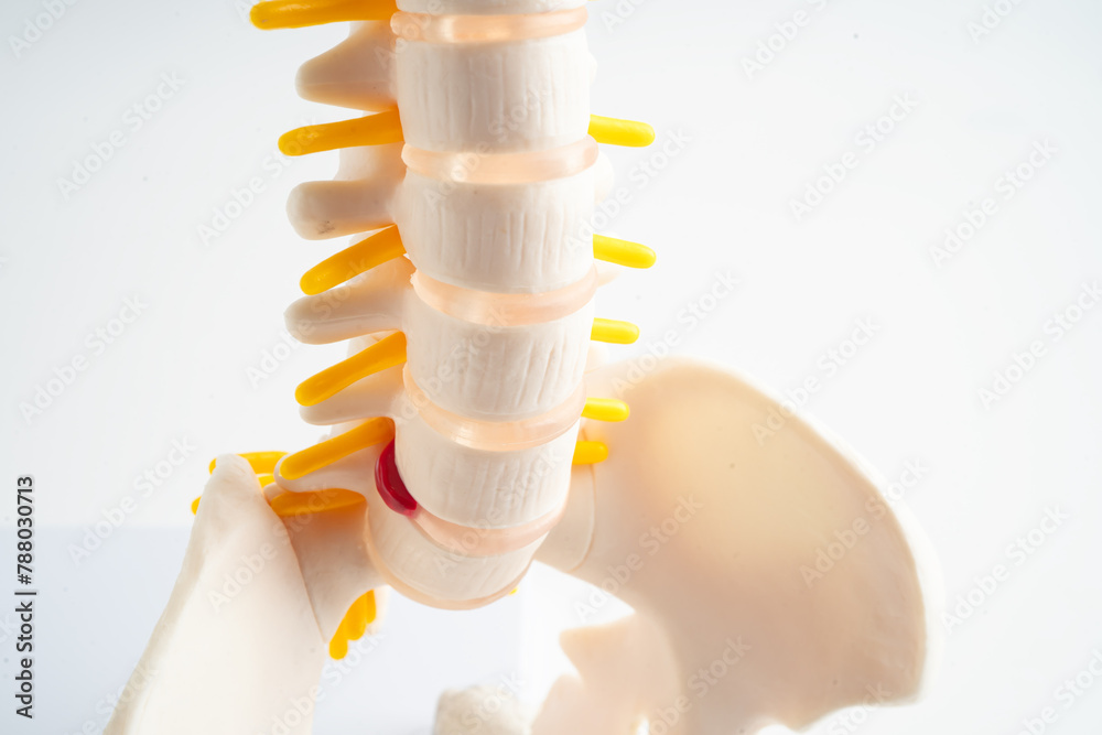 Lumbar spine displaced herniated disc fragment, spinal nerve and bone ...