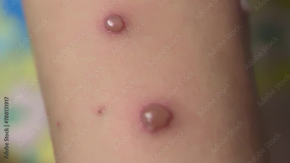 In-Depth 4K Look: Blister-Like Lesions on Kid’s Skin with Monkeypox ...