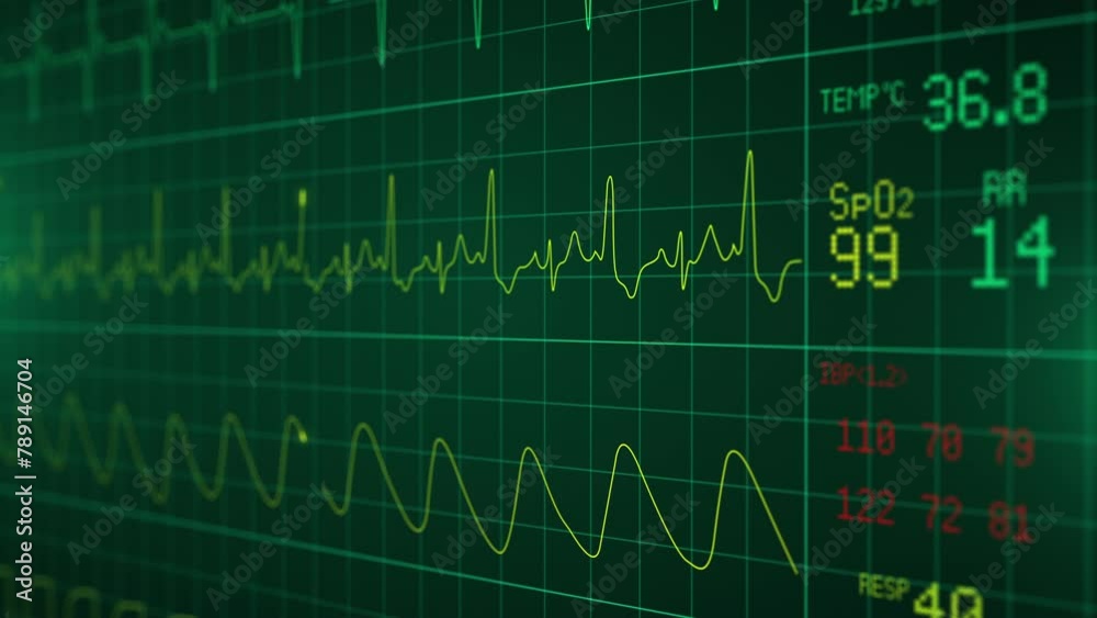 Patient monitor displays vital signs ECG electrocardiogram EKG, oxygen ...