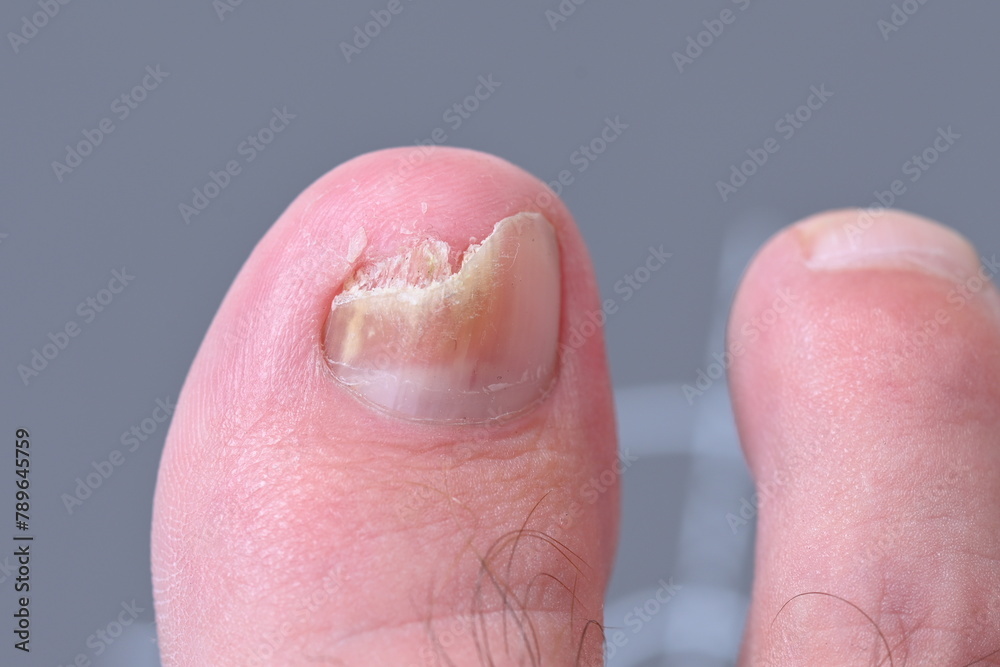 mycosis Fungal infection of the big toe nails. Fungal infection of ...