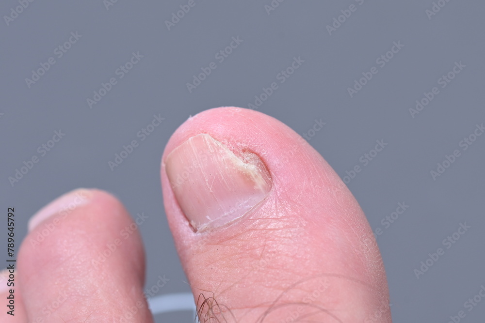 mycosis Fungal infection of the big toe nails. Fungal infection of ...