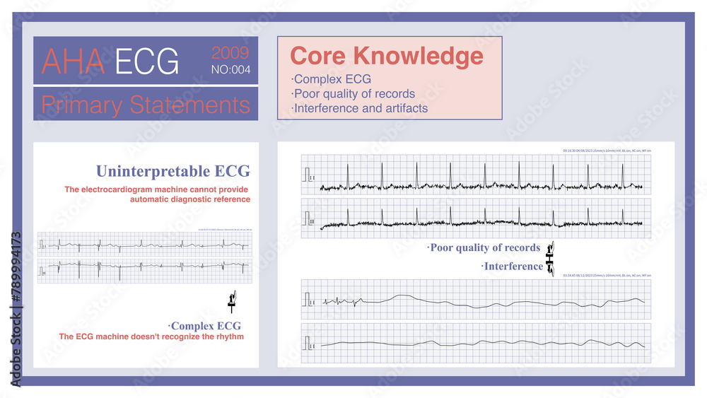 When the ECG is too complex, the recording quality is poor, or it is ...