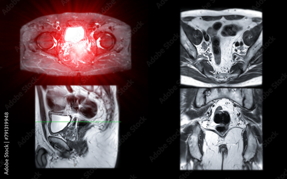MRI of the prostate gland reveals Focal abnormal SI lesion at left PZpl ...