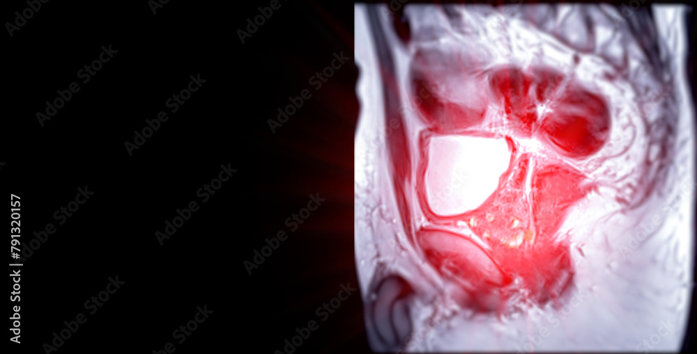 MRI of the prostate gland reveals Focal abnormal SI lesion at left PZpl ...