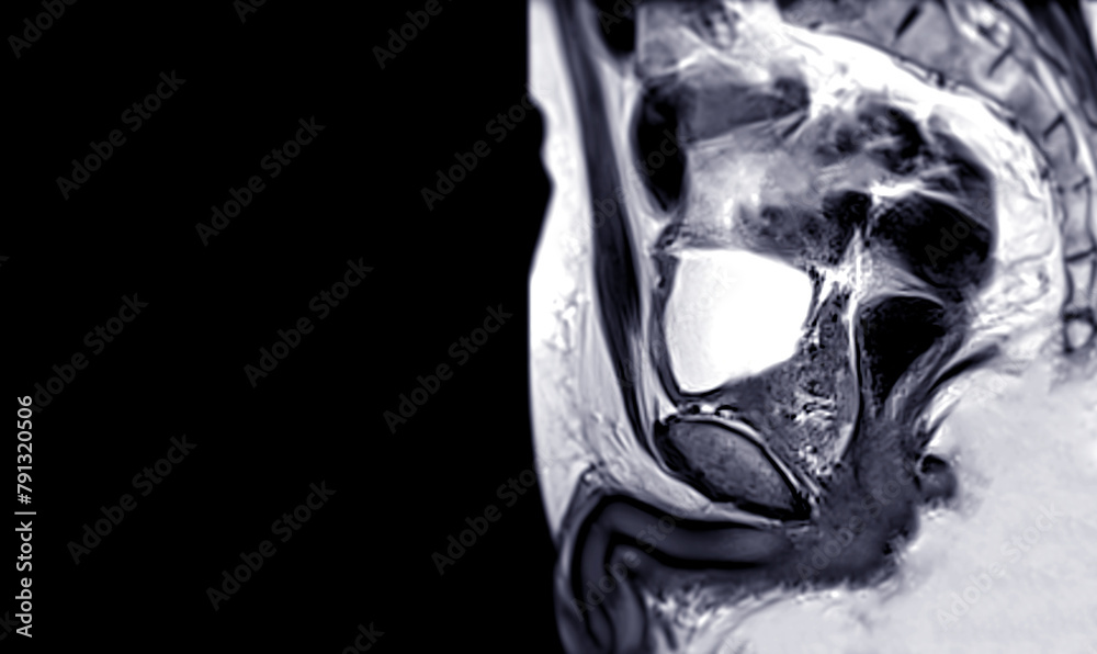 MRI of the prostate gland reveals Focal abnormal SI lesion at left PZpl ...