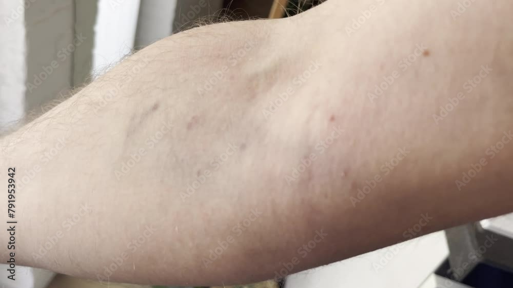 Vein hematoma of patient's arm after intravenous dripping in hospital ...
