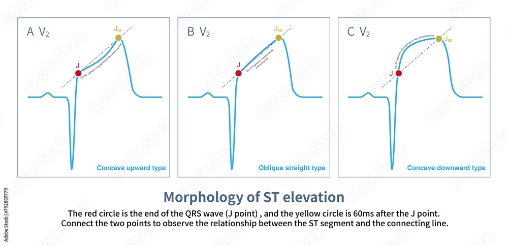 According to the offset amplitude of the ST segment at J point and J60 ...