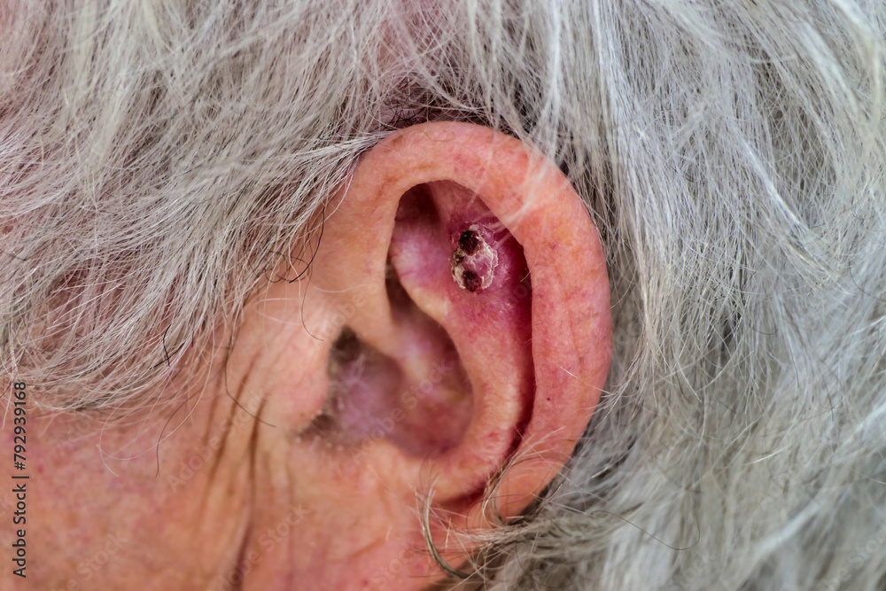 Basal Cell Carcinoma On An Ear From Over Exposure To Uva Particularly Sunlight Resulting In The