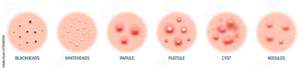 Body skin acne type blackheads, whiteheads, papule, pustule, cyst and ...